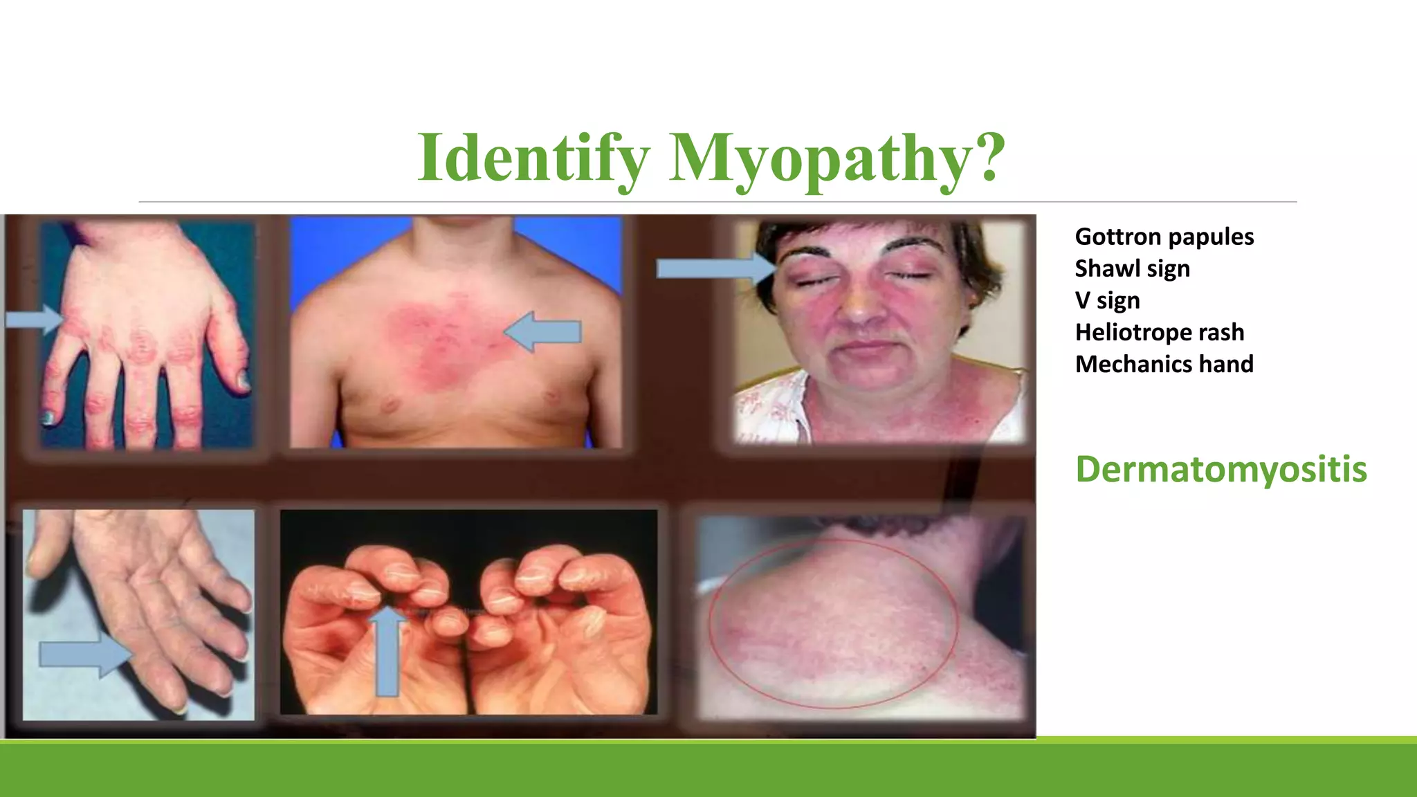 Approach to myopathy | PPTX
