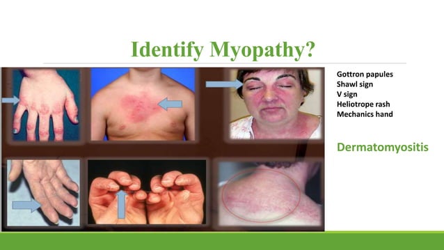 Approach to myopathy | PPTX