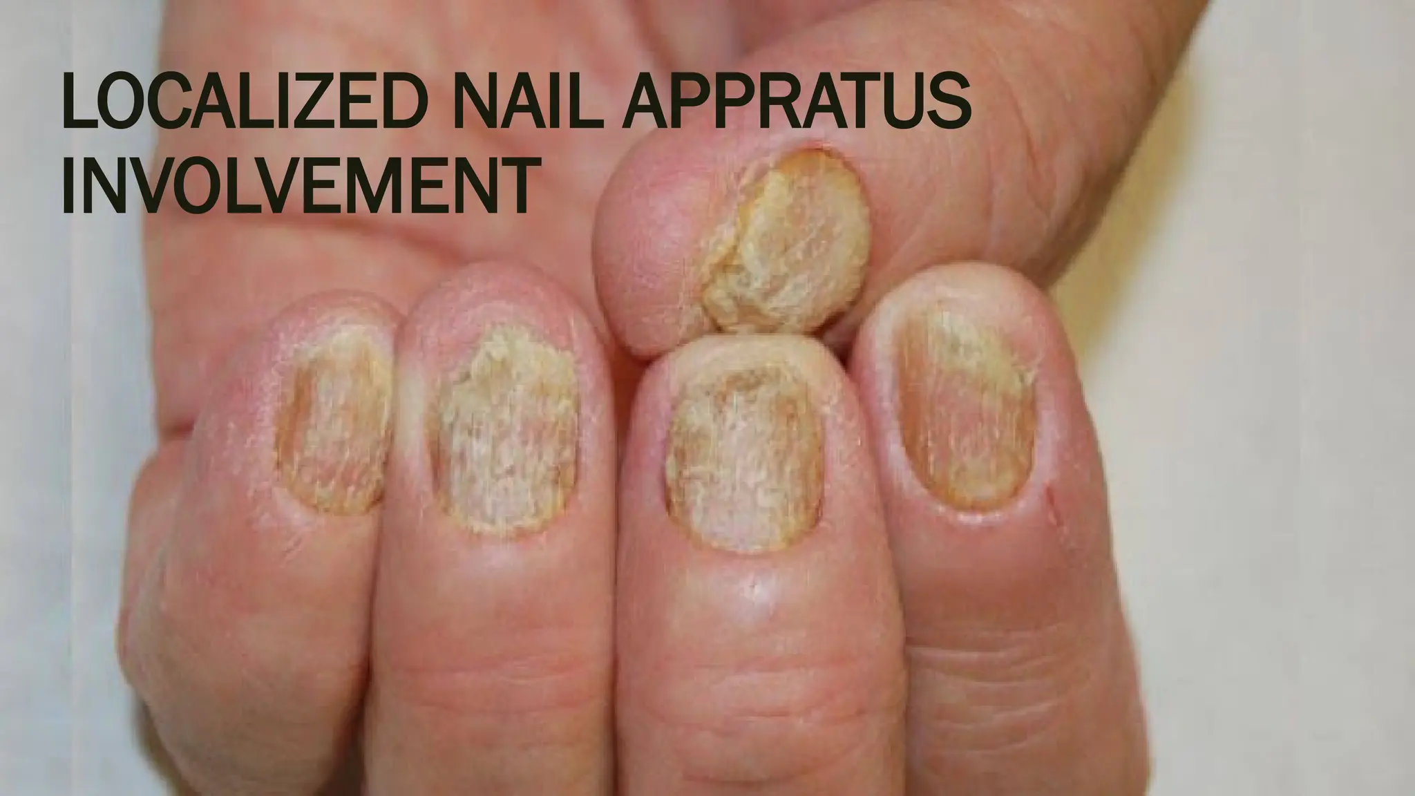 APPROACH TO NAIL DYSTROPHY FINAL..Everything about the nail.pptx