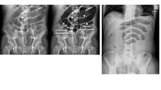 Approach to nausea and vomting- general medicine- gastroenterology | PDF
