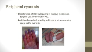 Approach to Neonatal Cyanosis and its management.pptx