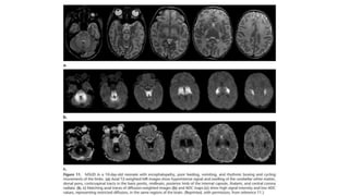 Approach to Neonatal Encephalopathy copy.pptx