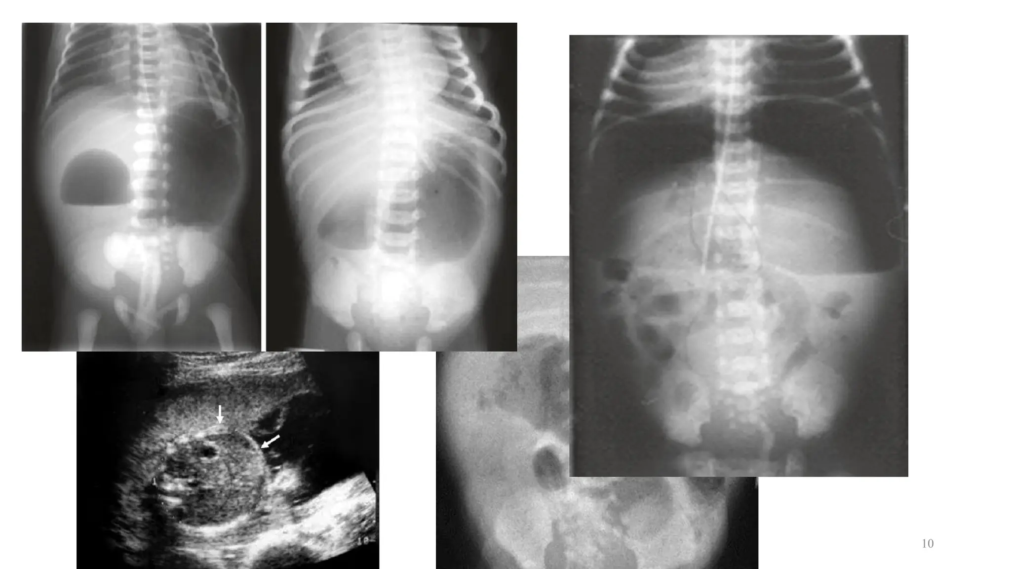 Approach to Neonatal Intestinal Obstruction.pptx