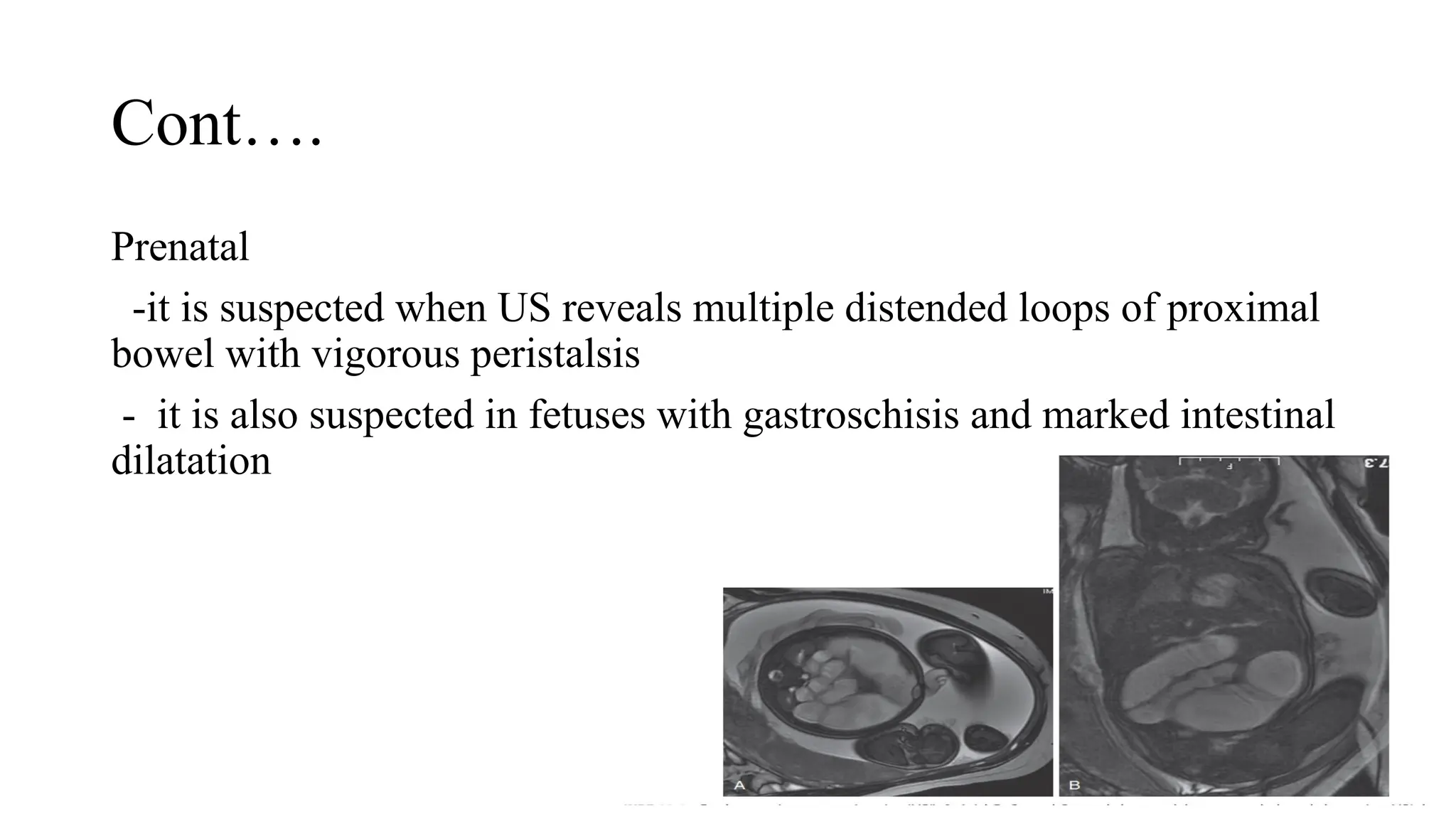 Approach to Neonatal Intestinal Obstruction.pptx