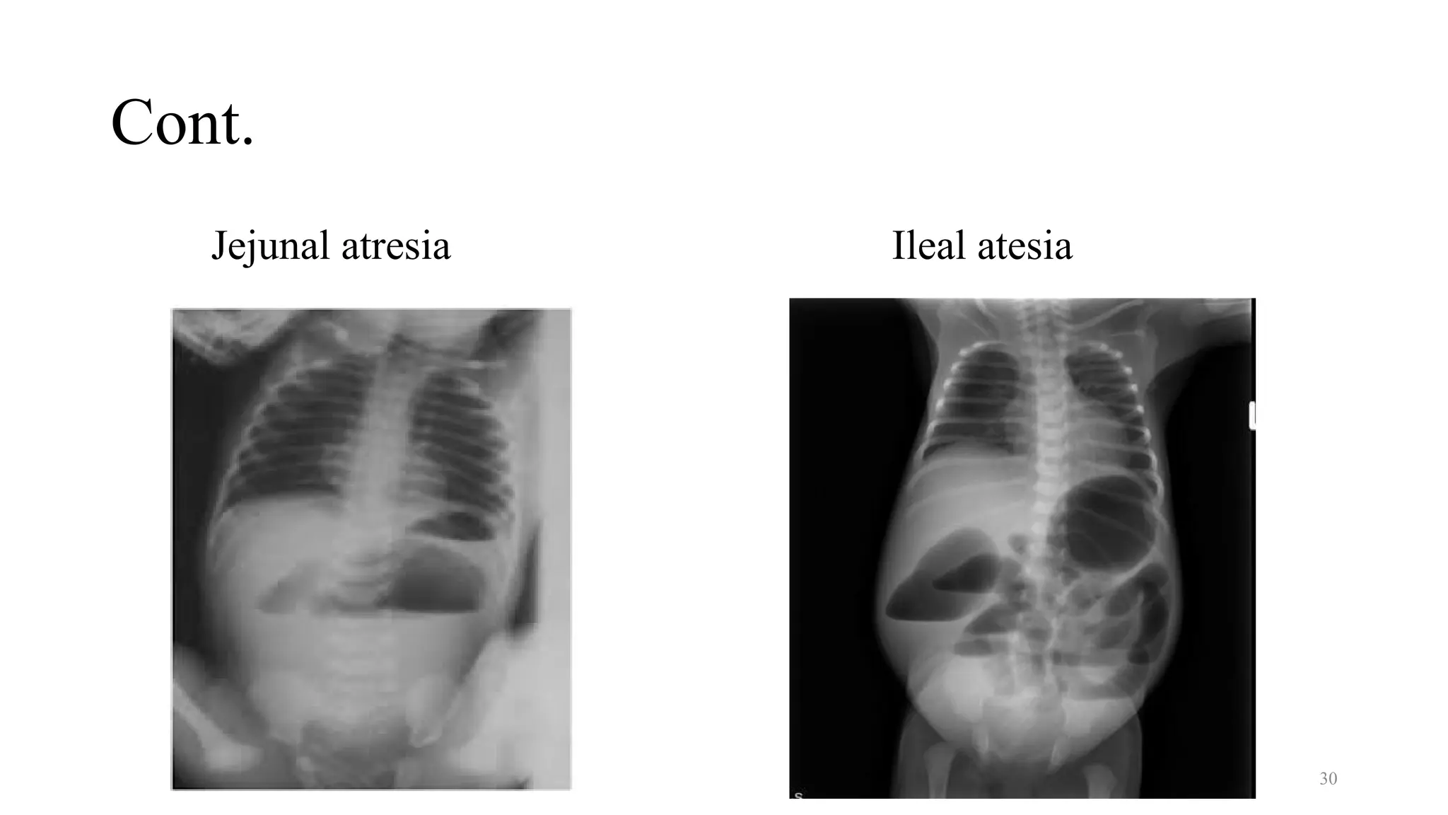 Approach to Neonatal Intestinal Obstruction.pptx