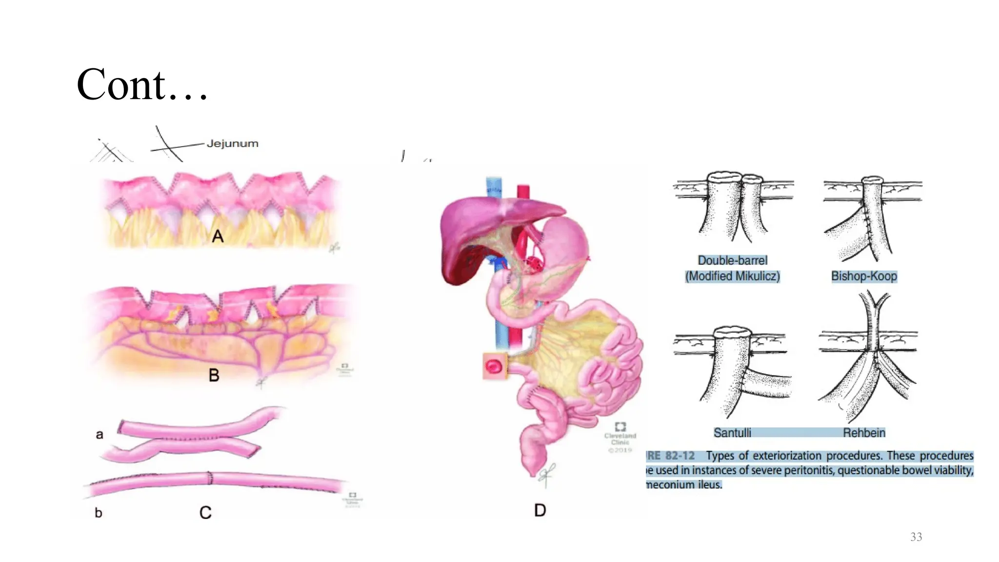 Approach to Neonatal Intestinal Obstruction.pptx