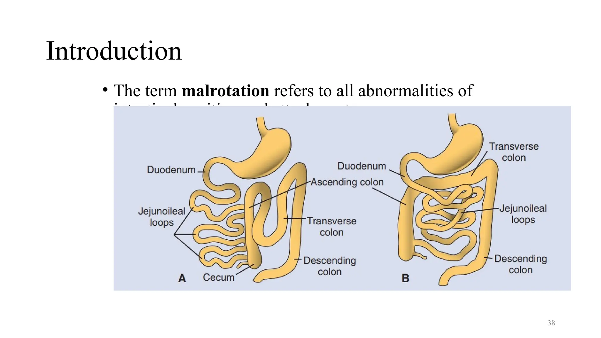 Approach to Neonatal Intestinal Obstruction.pptx