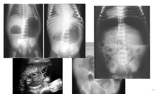 Approach to Neonatal Intestinal Obstruction.pptx | Pregnancy ...