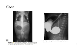Approach to Neonatal Intestinal Obstruction.pptx