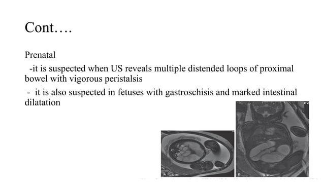 Approach to Neonatal Intestinal Obstruction.pptx | Pregnancy ...