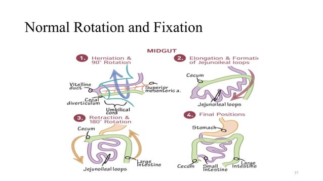 Approach to Neonatal Intestinal Obstruction.pptx | Pregnancy ...