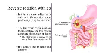 Approach to Neonatal Intestinal Obstruction.pptx