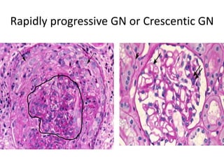 Approach to Nephritic Syndrome | PPTX