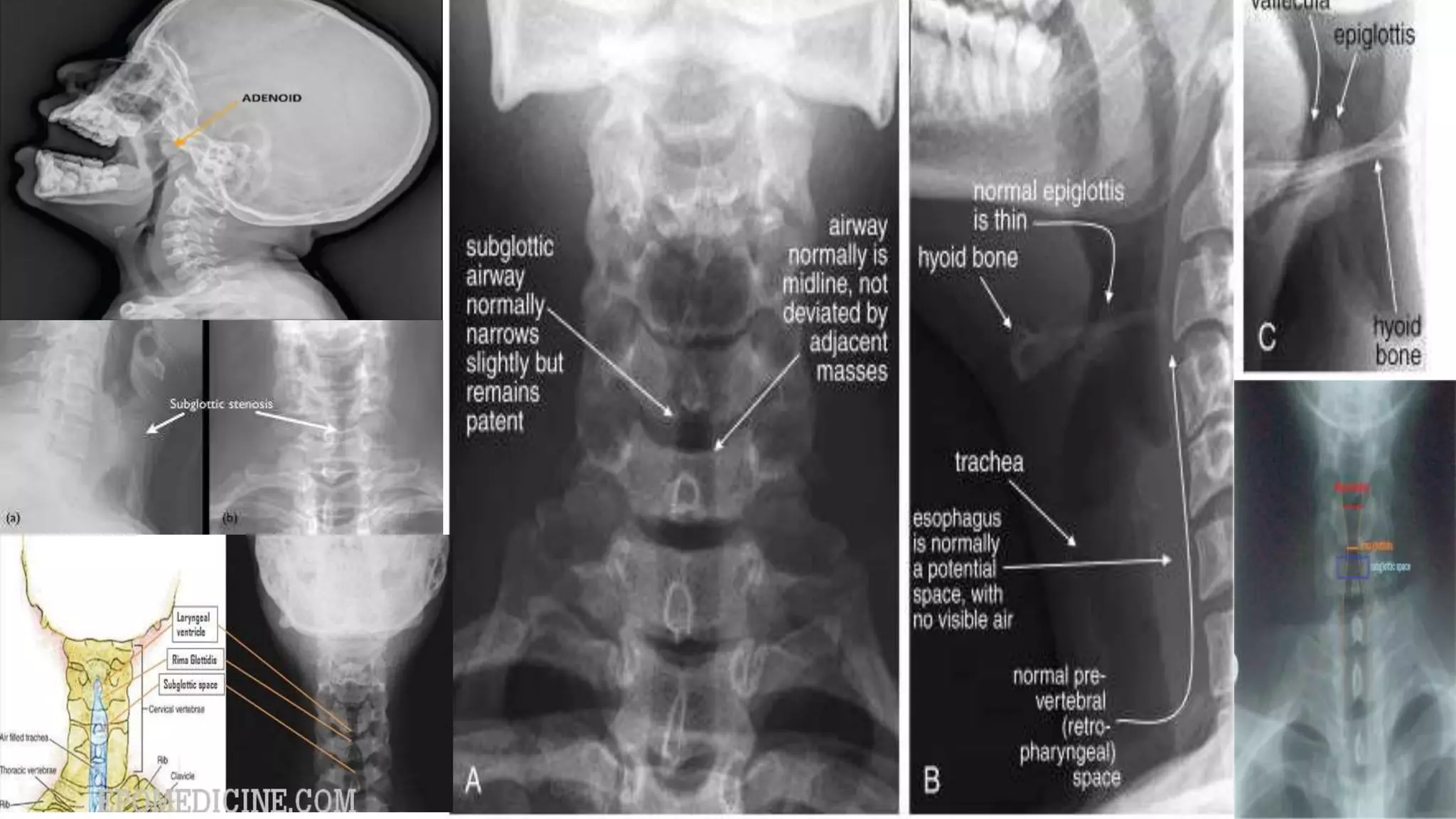 Approach to non-infectious Upper Airway Obstruction “Stridor” in ...