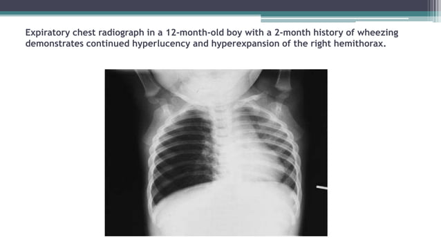 Approach to non-infectious Upper Airway Obstruction “Stridor” in ...
