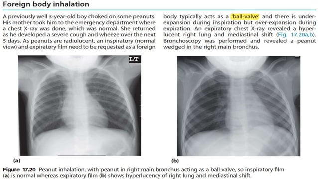 Approach to non-infectious Upper Airway Obstruction “Stridor” in ...