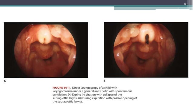 Approach to non-infectious Upper Airway Obstruction “Stridor” in ...