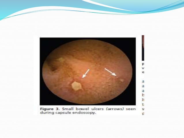 Approach to occult bleeding | PPTX | Blood Disorders | Diseases and ...