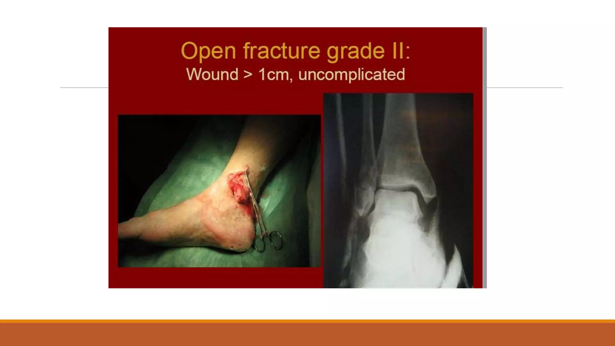 Approach to open fractures | PPTX