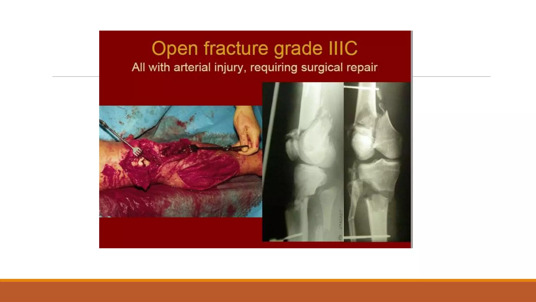 Approach to open fractures | PPTX