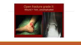 Approach to open fractures | PPTX