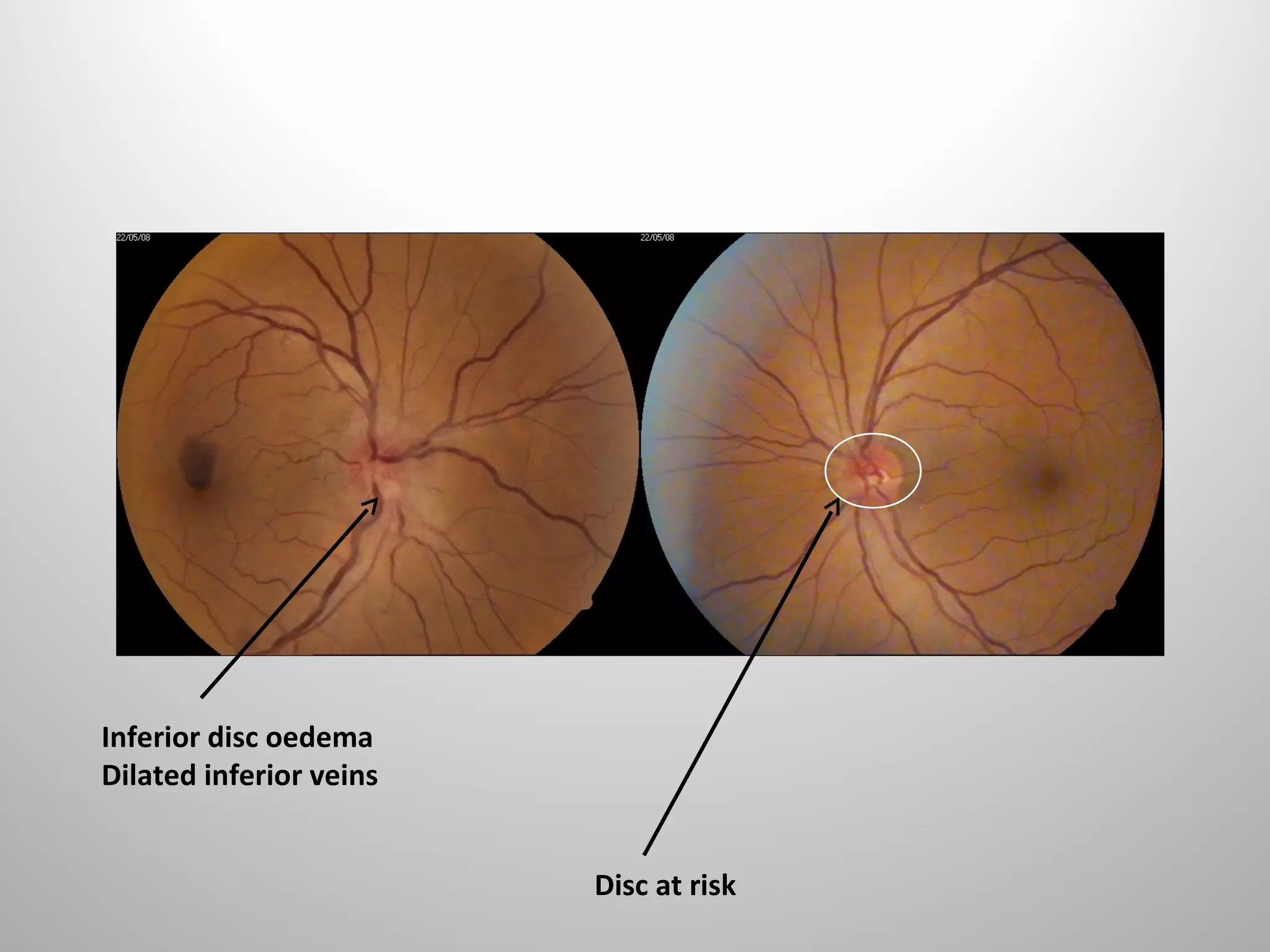 Approach to Disc Pallor and Automated Fields in Neuro-ophthalmology | PPT