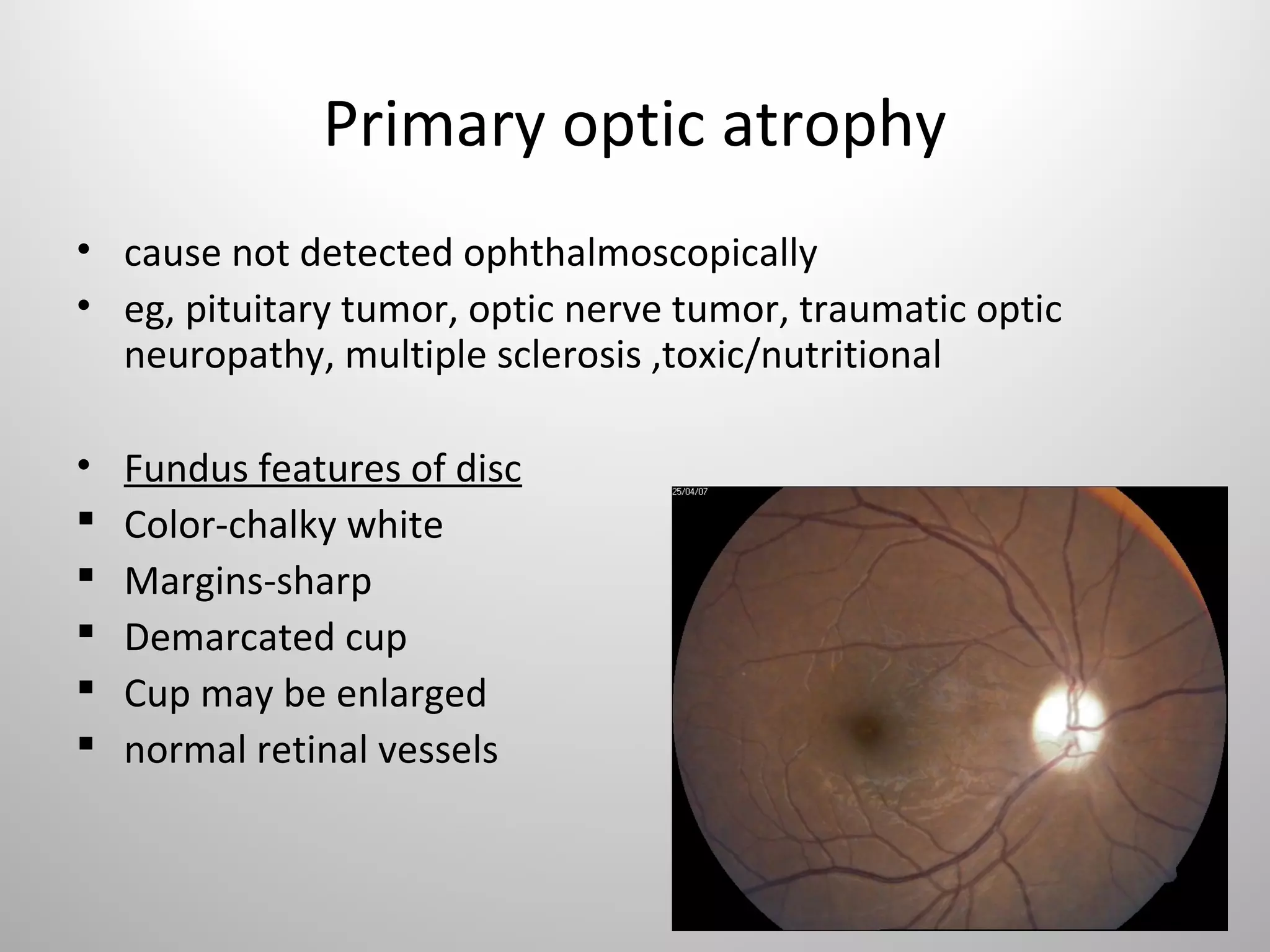 Approach to Disc Pallor and Automated Fields in Neuro-ophthalmology | PPT