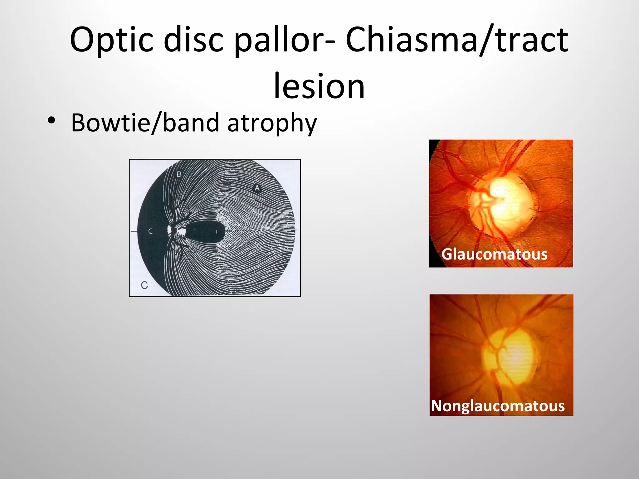 Approach to Disc Pallor and Automated Fields in Neuro-ophthalmology | PPT