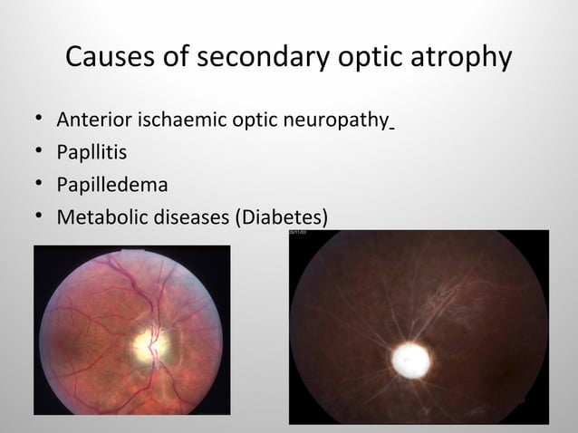 Approach to Disc Pallor and Automated Fields in Neuro-ophthalmology ...