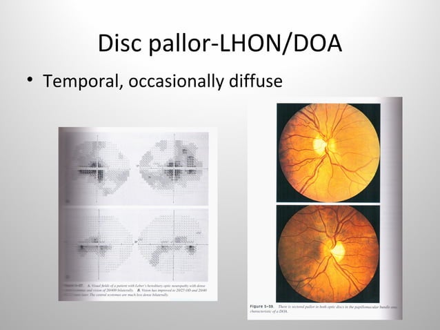 Approach to Disc Pallor and Automated Fields in Neuro-ophthalmology ...