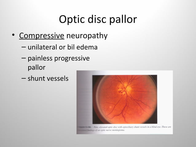 Approach to Disc Pallor and Automated Fields in Neuro-ophthalmology ...