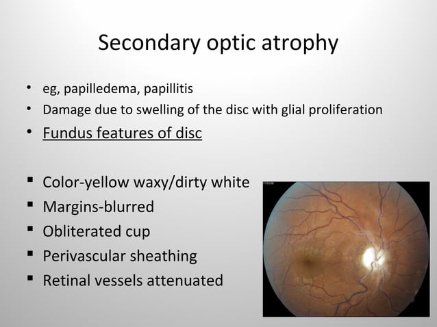 Approach to Disc Pallor and Automated Fields in Neuro-ophthalmology ...