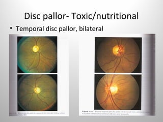 Ms And Pallor Optic Nerve