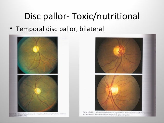 Approach to Disc Pallor and Automated Fields in Neuro-ophthalmology