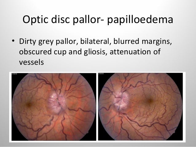 Approach to Disc Pallor and Automated Fields in Neuro-ophthalmology