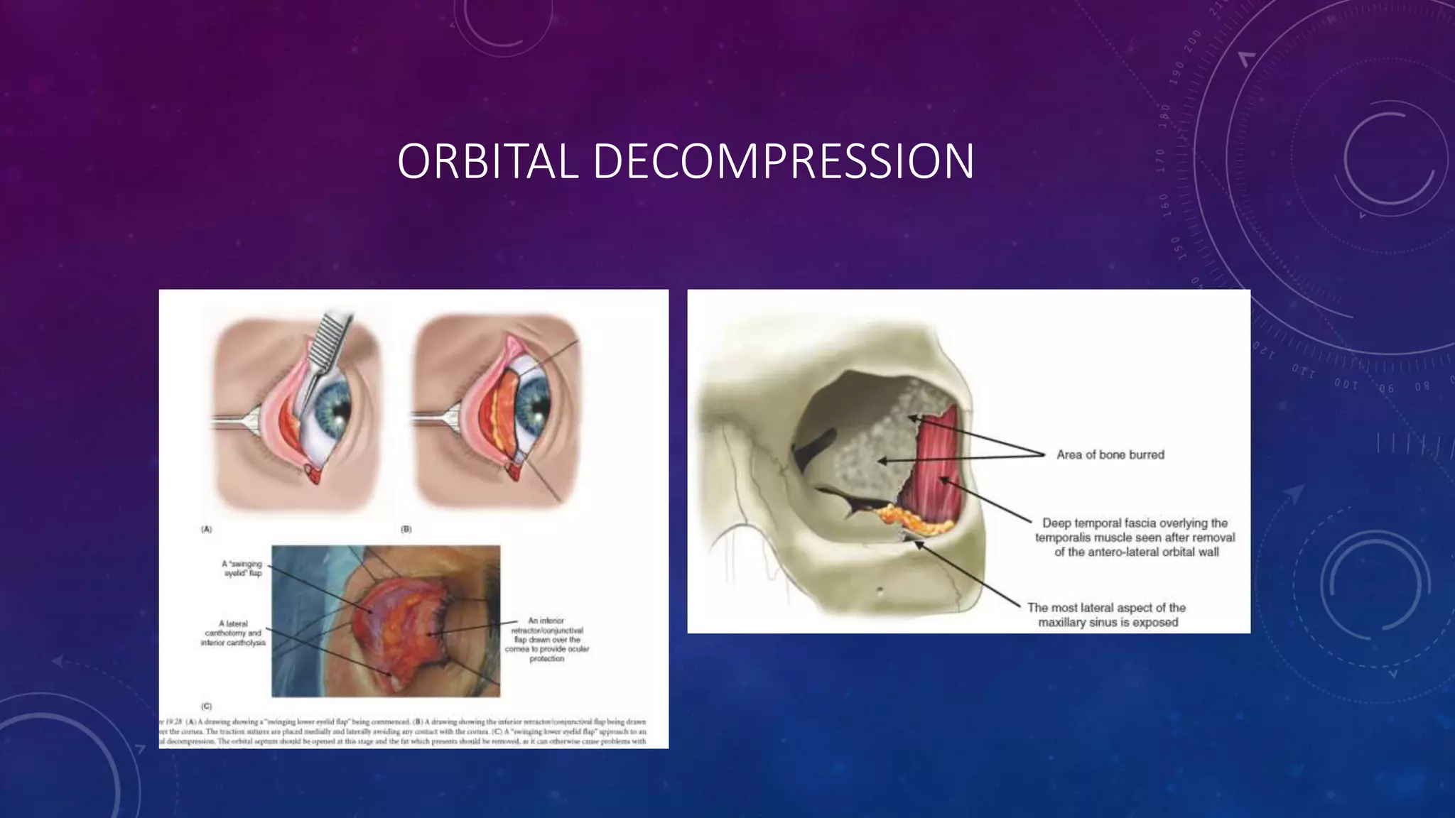 Approach to orbital surgery. | PPTX