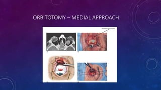 Approach to orbital surgery. | PPTX