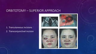 Approach to orbital surgery. | PPTX
