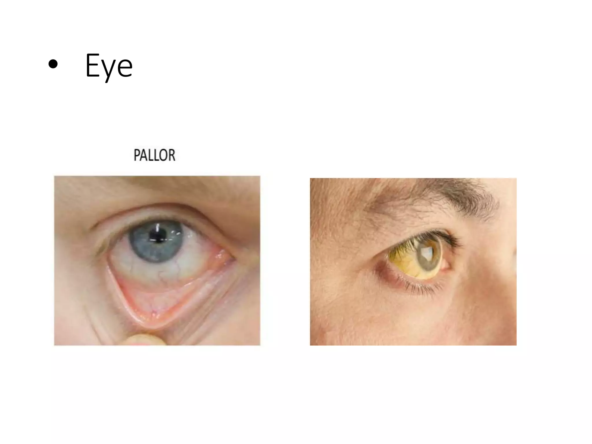 Approach to pallor full compilation.pptx