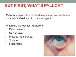 Approach to pallor full compilation.pptx
