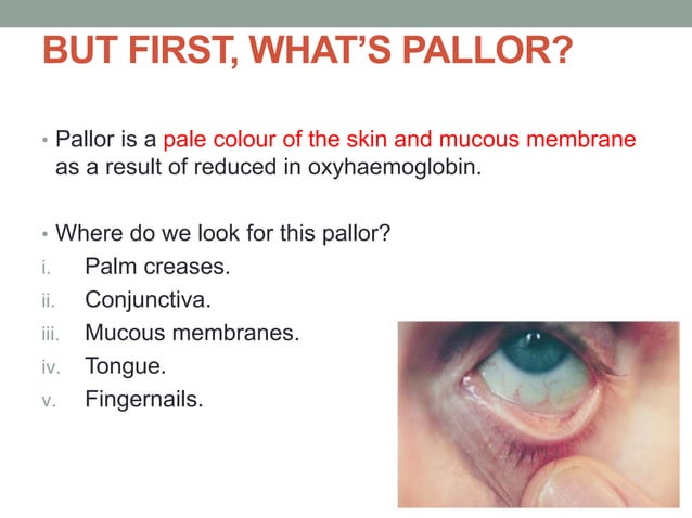 Approach to pallor full compilation.pptx