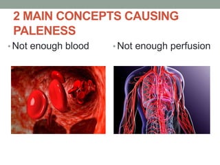 Approach to pallor full compilation.pptx