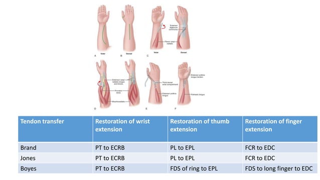 Approach to paralytic hand IOM Peripheral Nerve | PPT