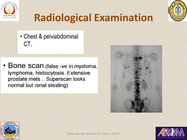 Approach to pathologic fractures in children | PPT