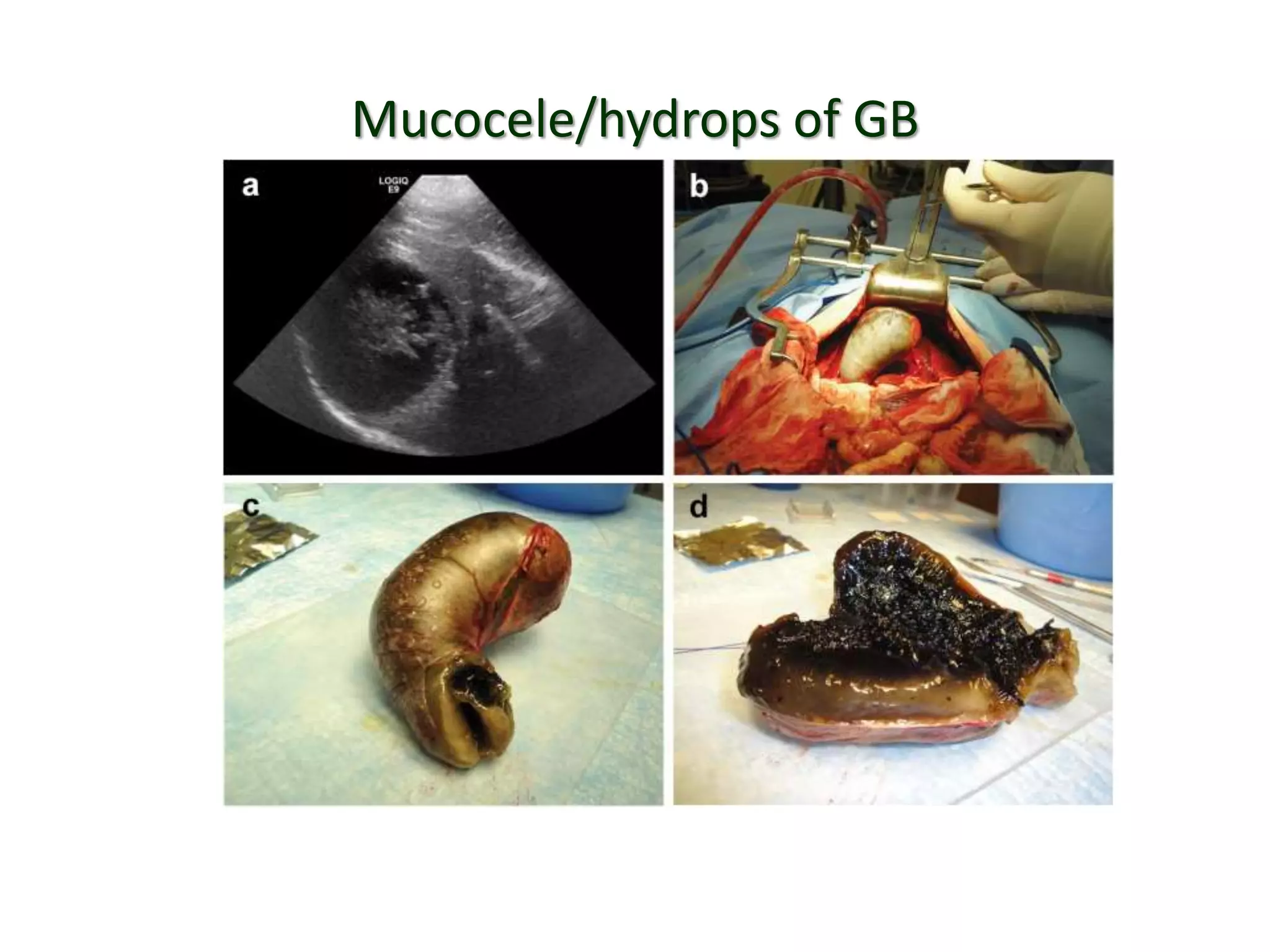 Approach to patient with gall bladder lump | PPTX