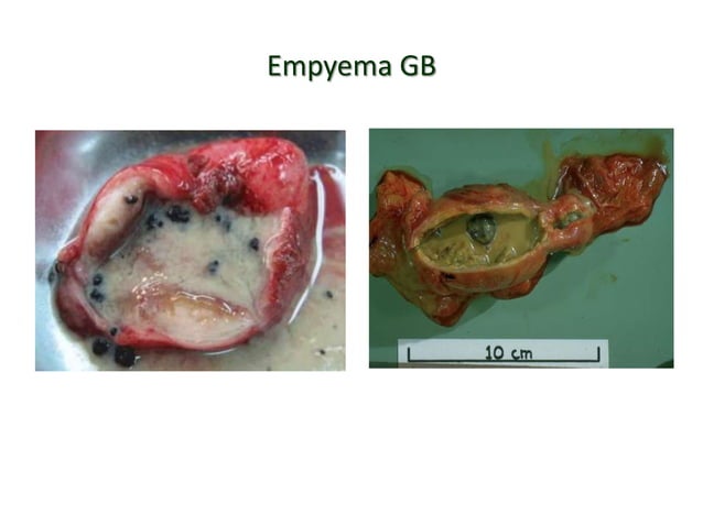 Approach to patient with gall bladder lump | PPTX