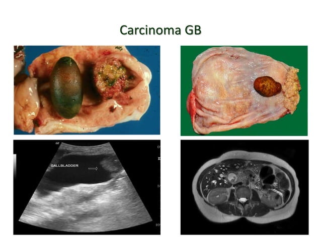 Approach to patient with gall bladder lump | PPTX