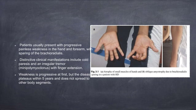 Approach to patient with peripheral neuropathy | PPT