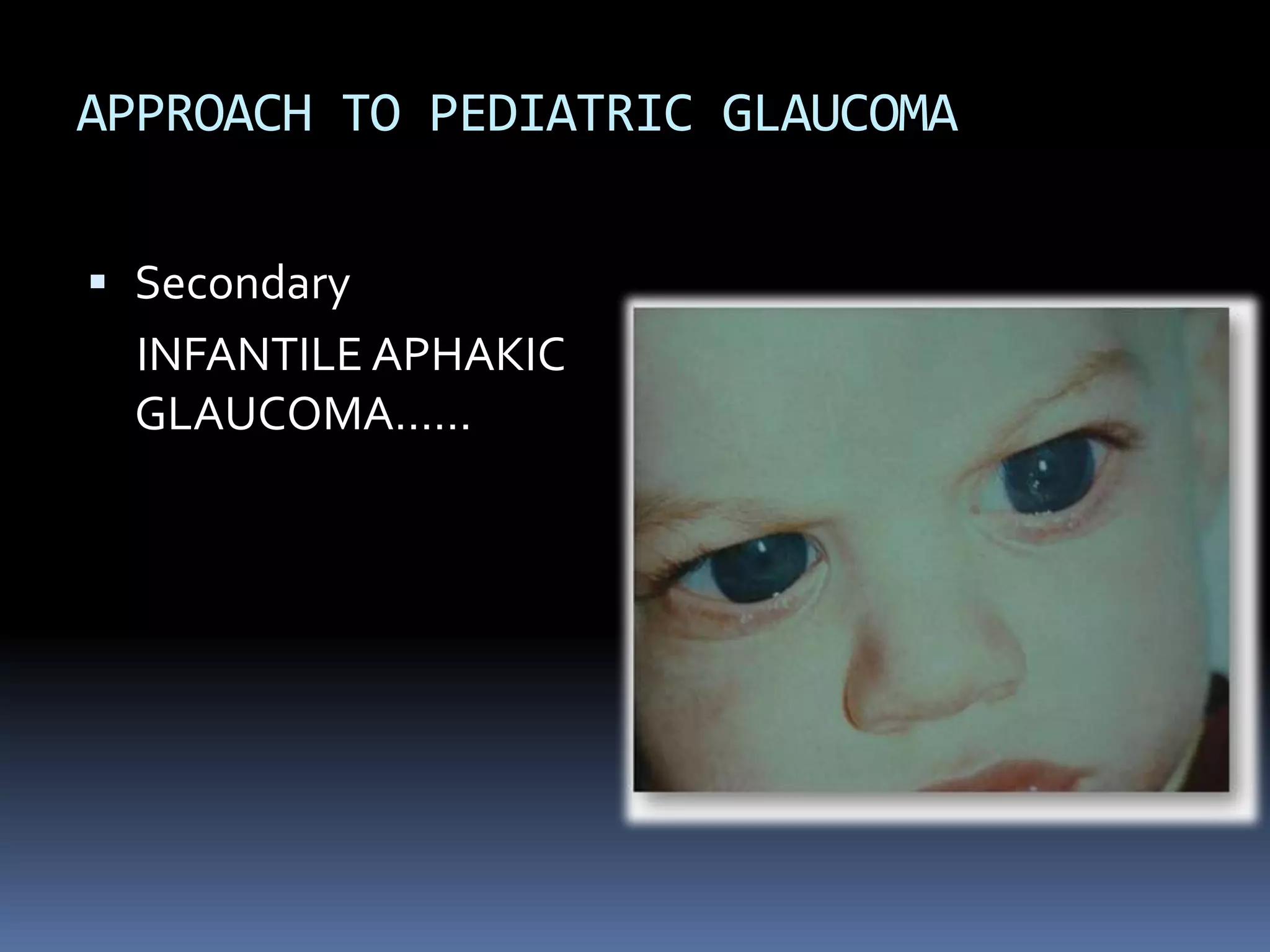 Approach to pediatric glaucoma | PPTX