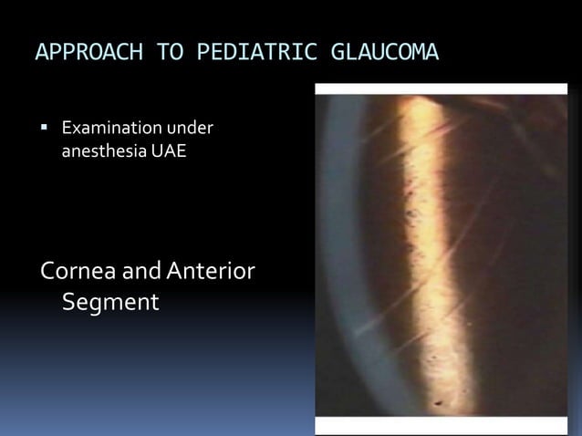 Approach to pediatric glaucoma | PPTX | Eye and Vision Conditions ...